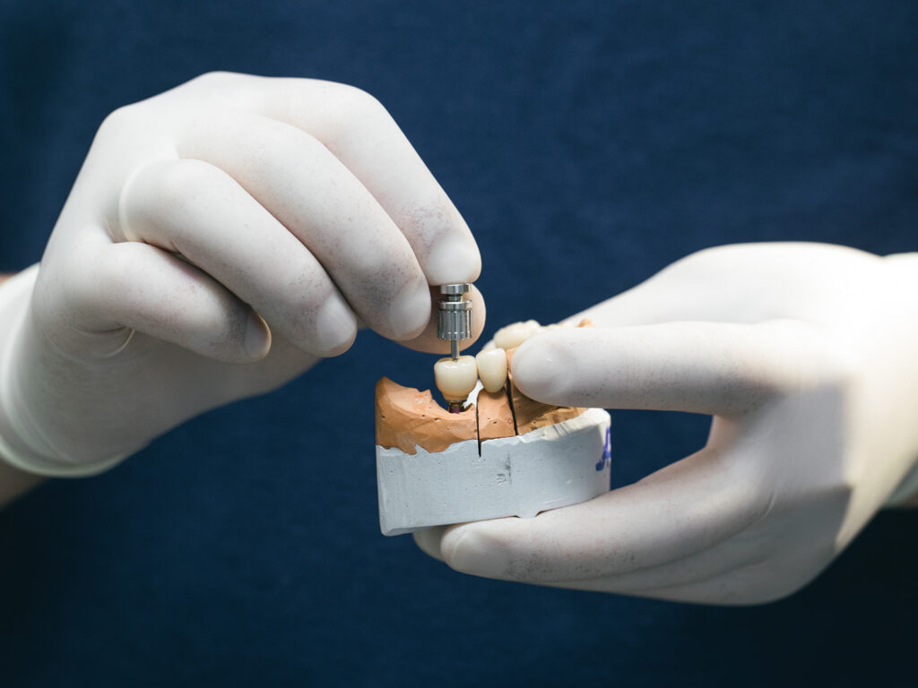 What Are Porcelain Fused To Metal (PFM) Restorations